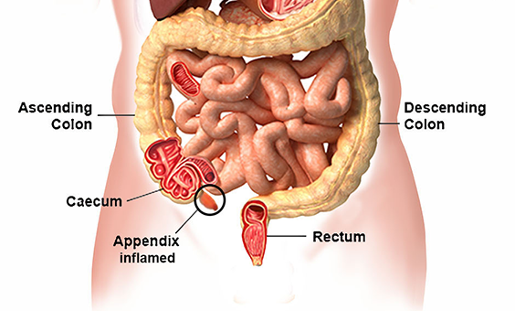 Human Appendix Inflamed